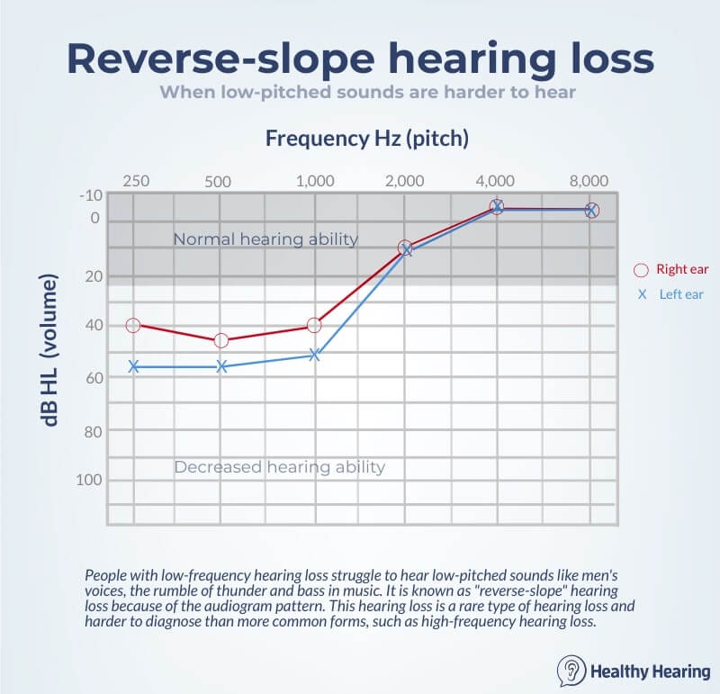 Reverse-Slope Hearing Loss: A Rare Type of Hearing Loss-(helped 86 ...